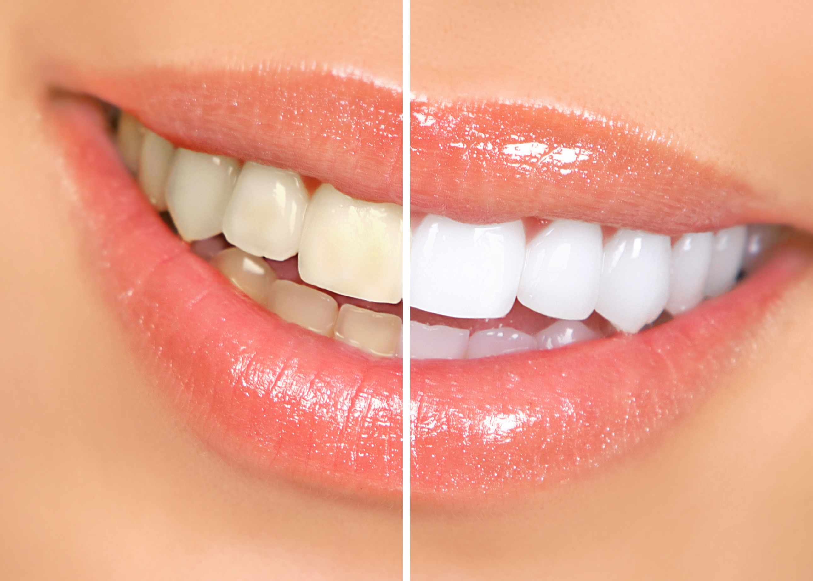 Tooth whitening - Ocean Orthodontic Clinic