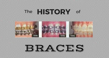 The History of Braces - Ocean Orthodontic Clinic